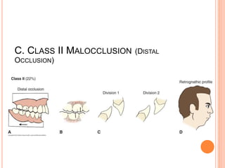 Distal occlusion | PPTX | Dental Health | Diseases and Conditions