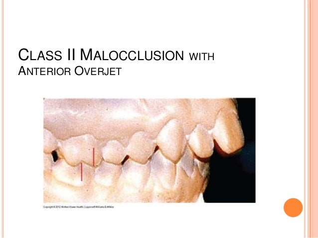 Distal occlusion