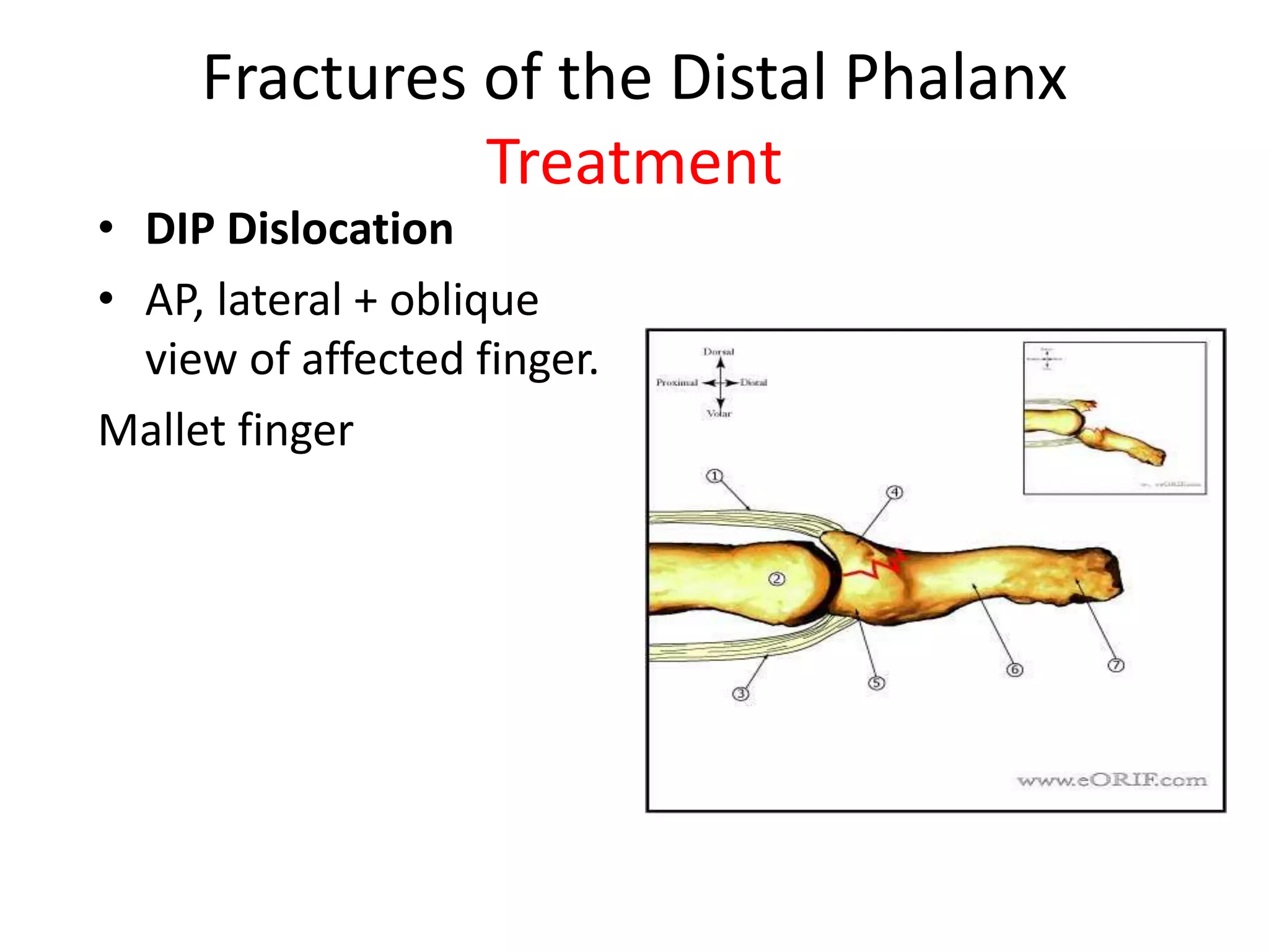 Distal phalanx fracture | PPTX
