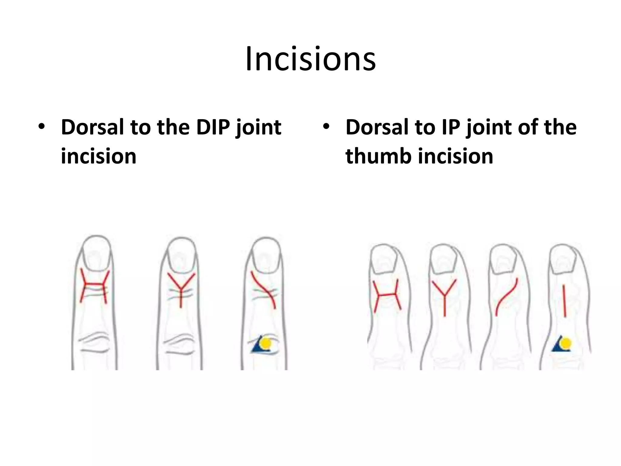 Distal phalanx fracture | PPT