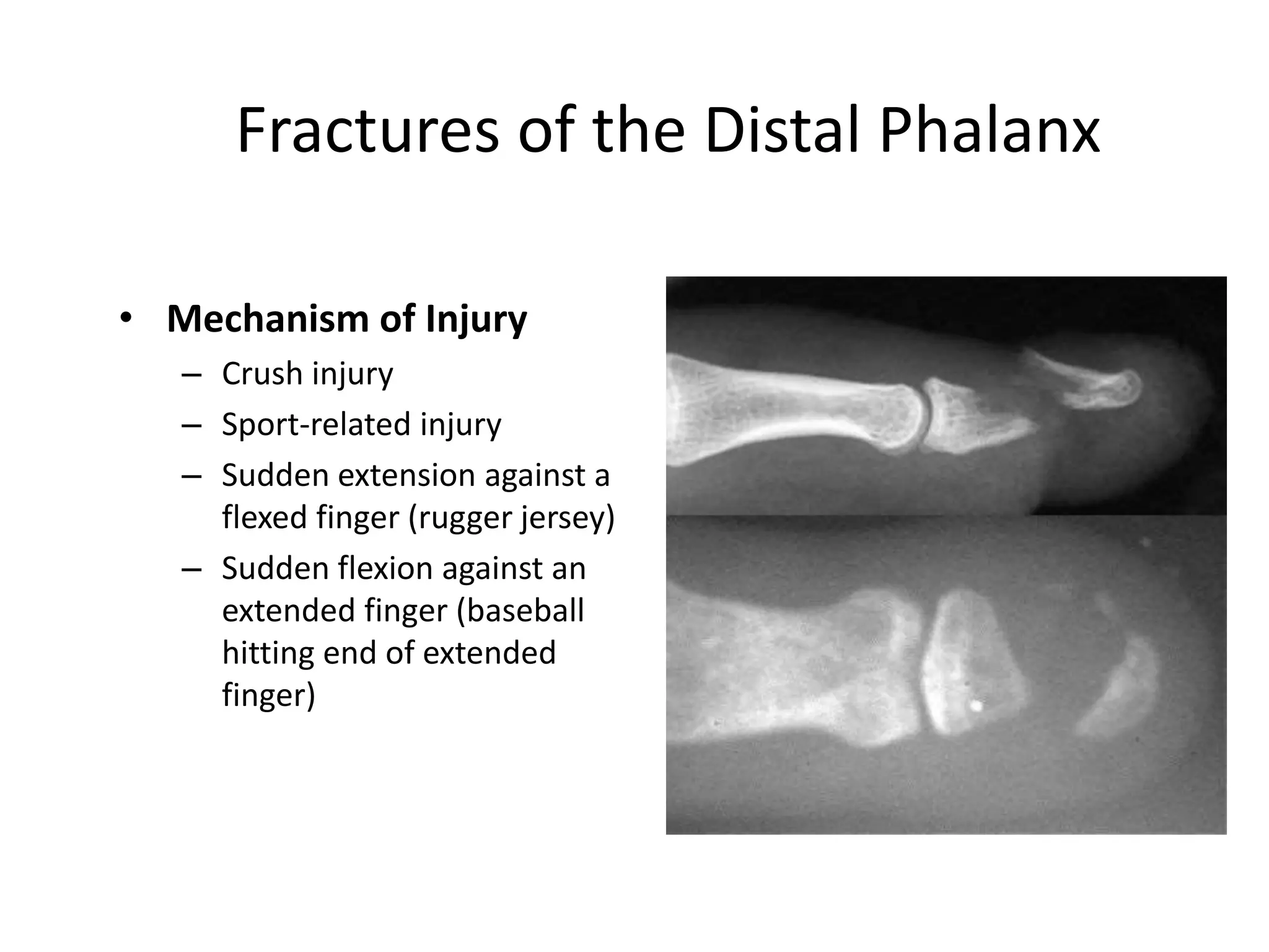 Distal phalanx fracture | PPTX