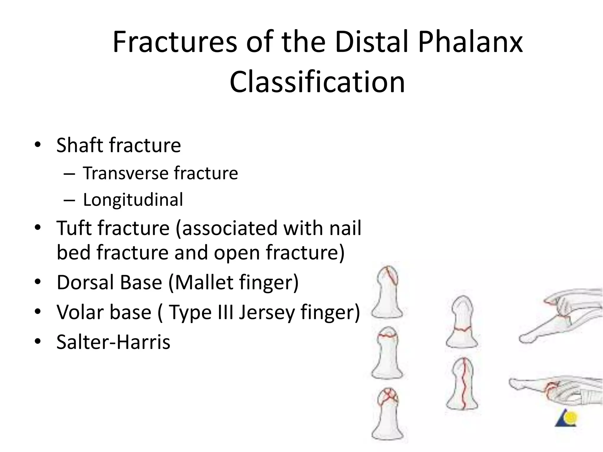 Distal phalanx fracture | PPTX