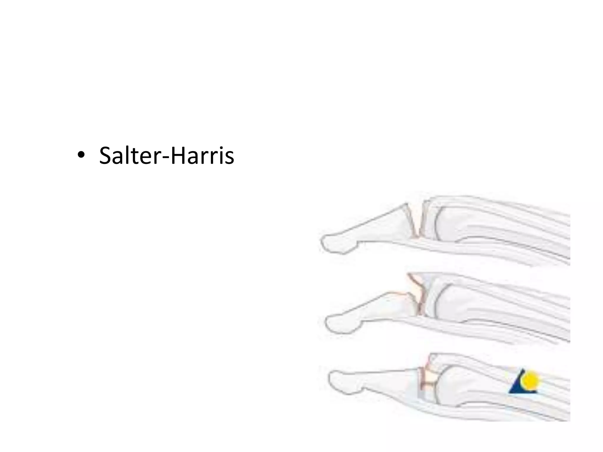 Distal phalanx fracture | PPTX