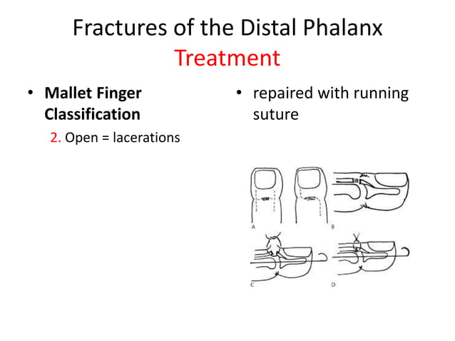 Distal phalanx fracture | PPTX