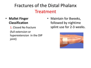 Distal Phalanx Fracture Splint