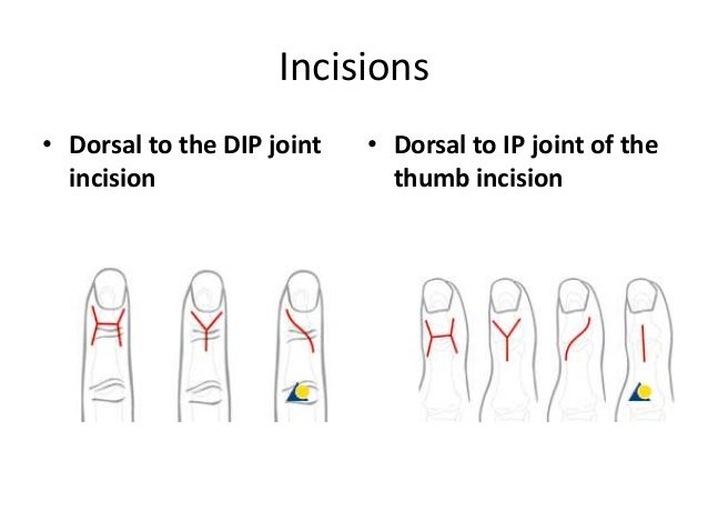 Distal phalanx fracture