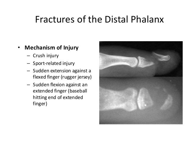 Distal phalanx fracture