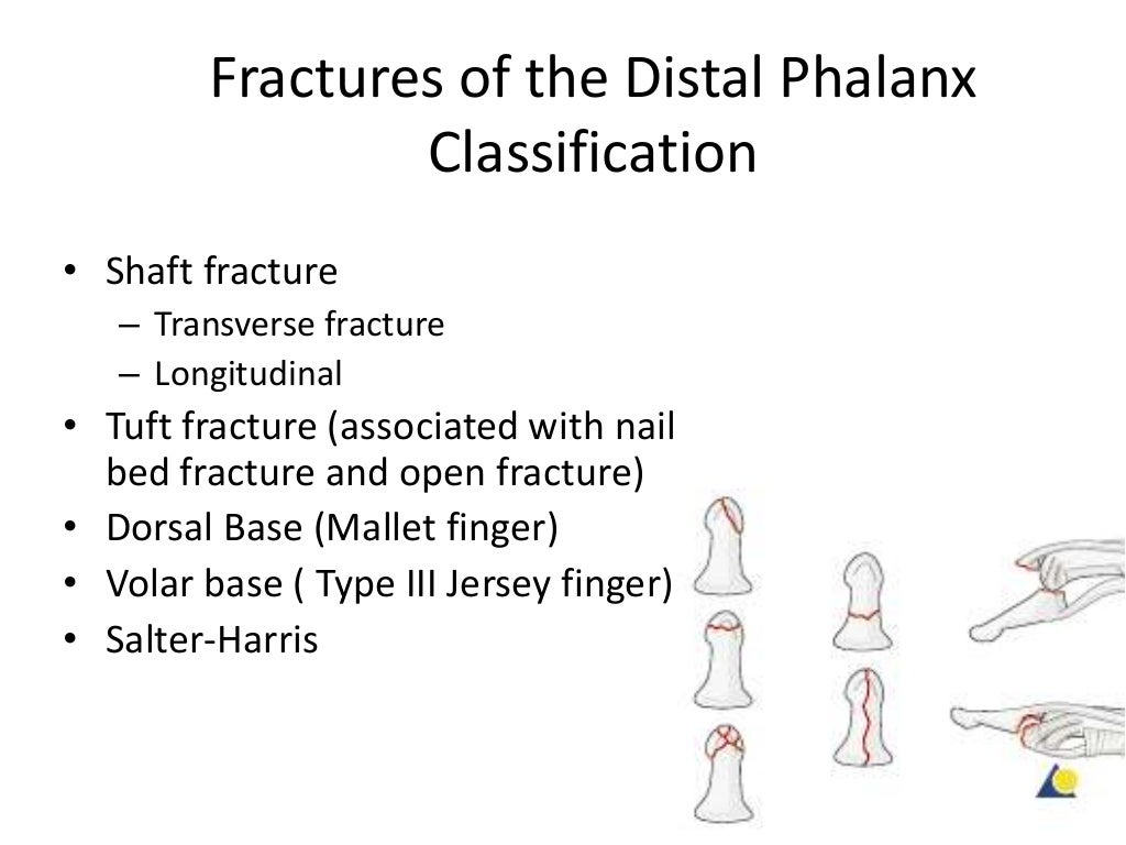 Distal phalanx fracture