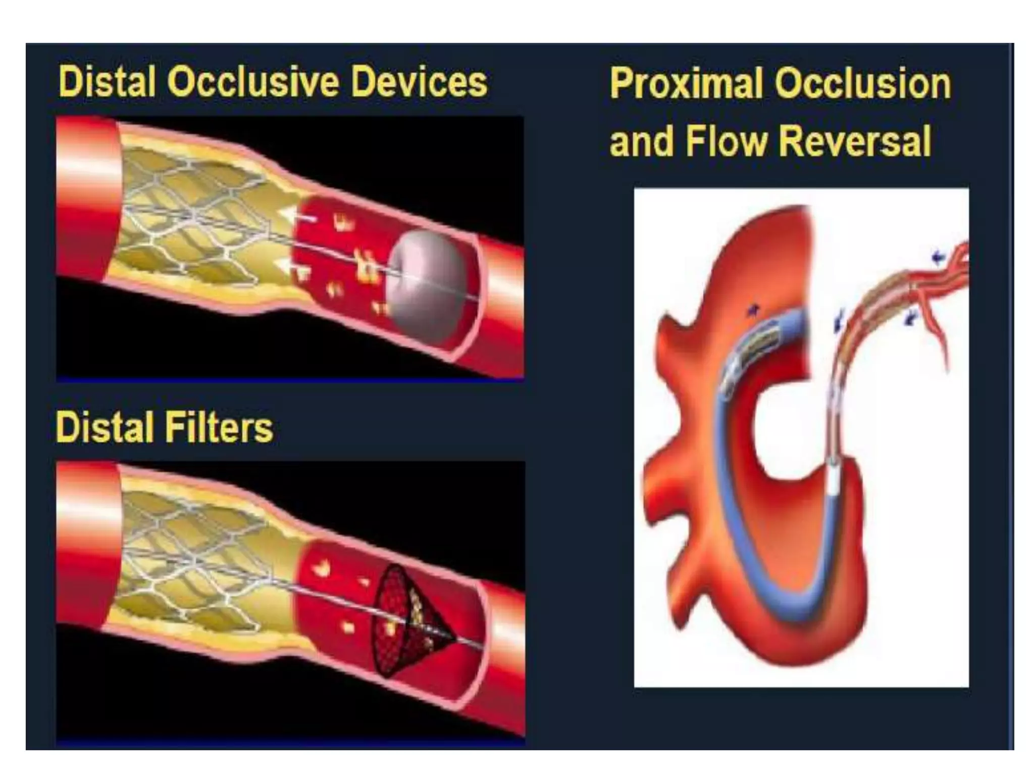 Distal protection device | PPTX