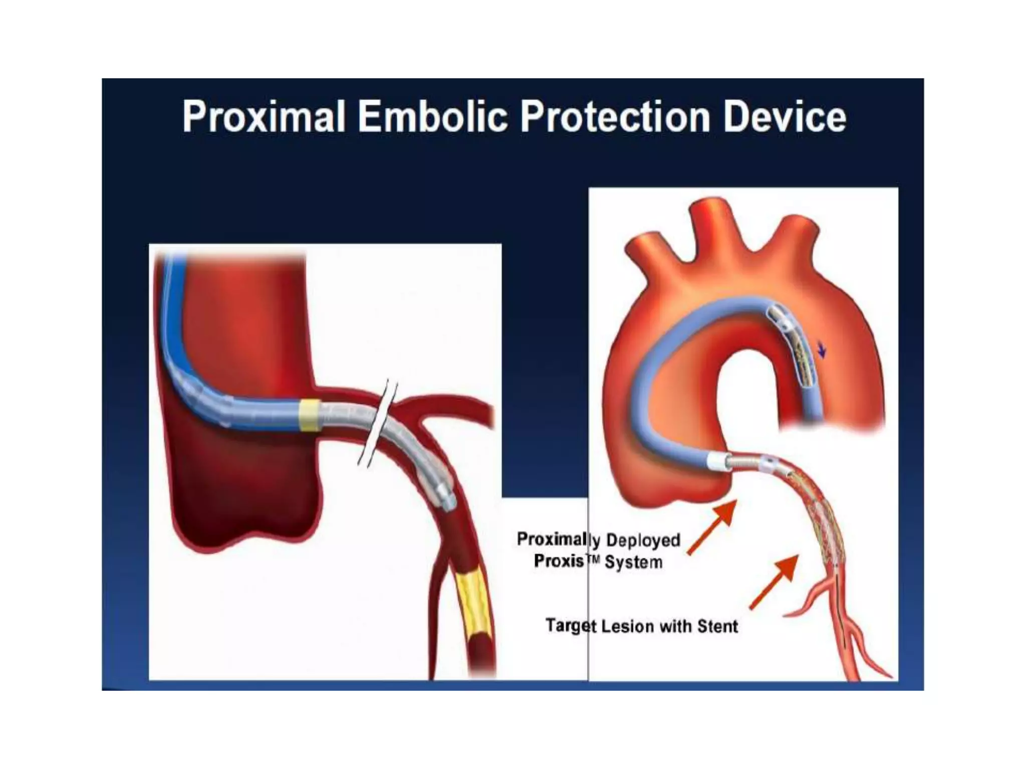 Distal protection device | PPTX | First Aid | Injuries