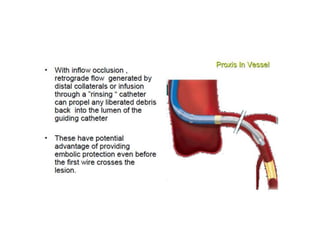 Distal protection device | PPTX