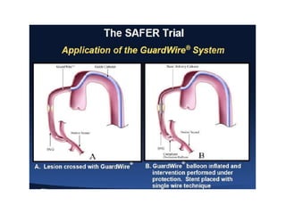 Distal protection device | PPTX