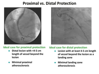 Distal protection device | PPT