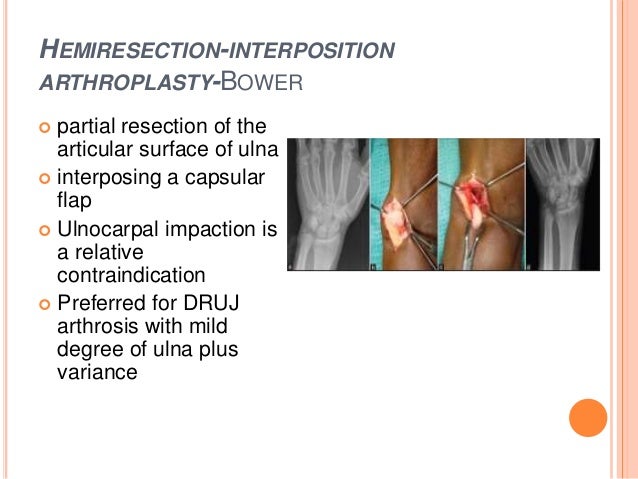 Distal radioulnar joint injuries