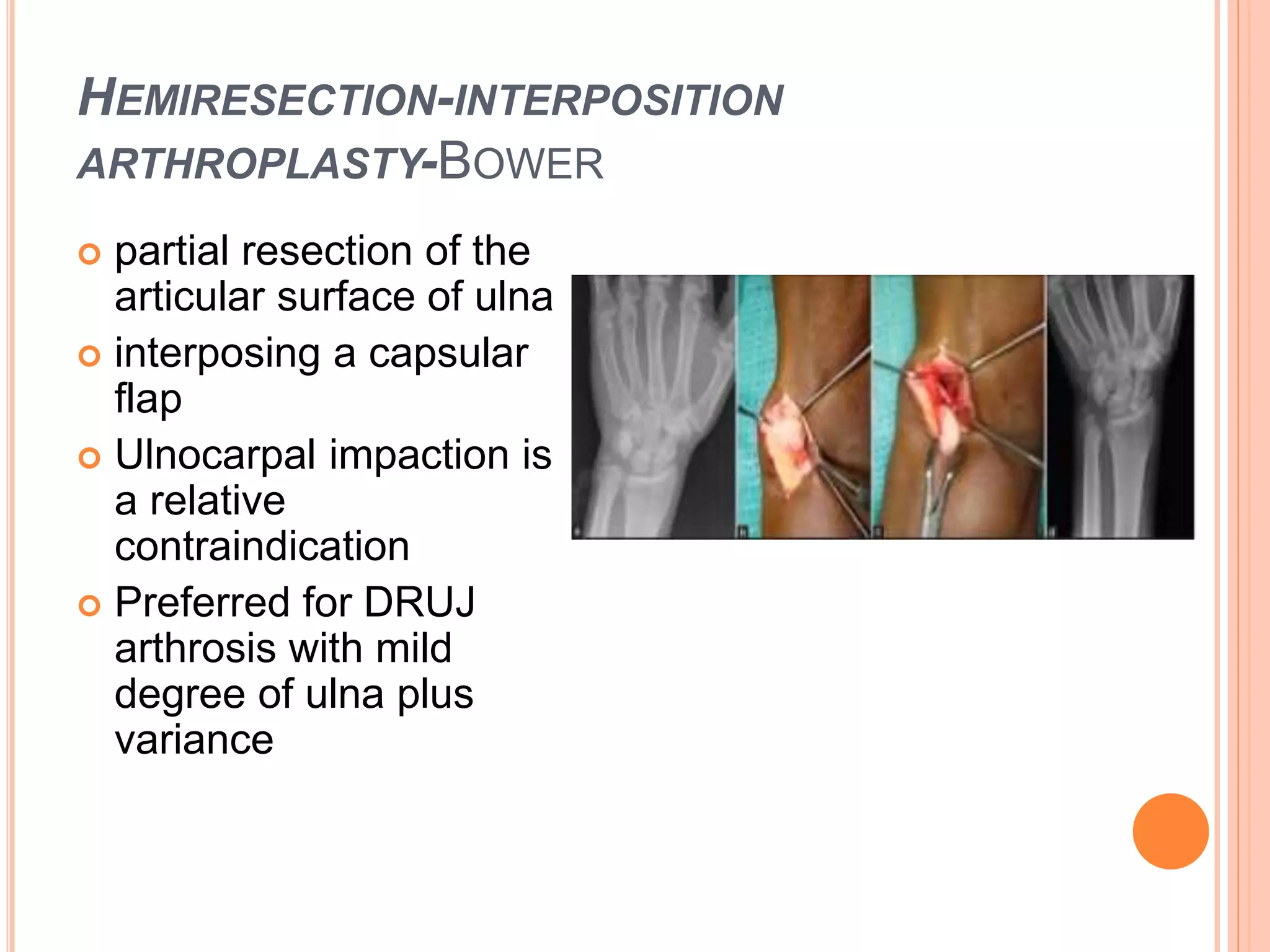 Distal radioulnar joint injuries | PPTX