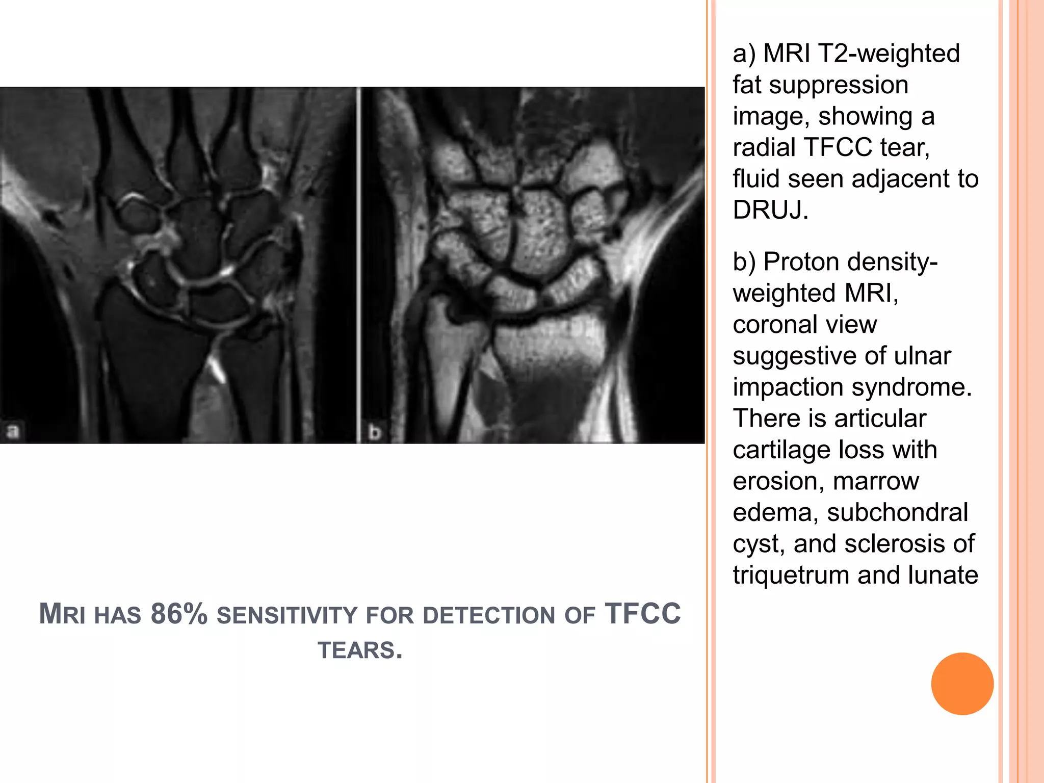Distal radioulnar joint injuries( DRUJ) and carpal instability | PPTX