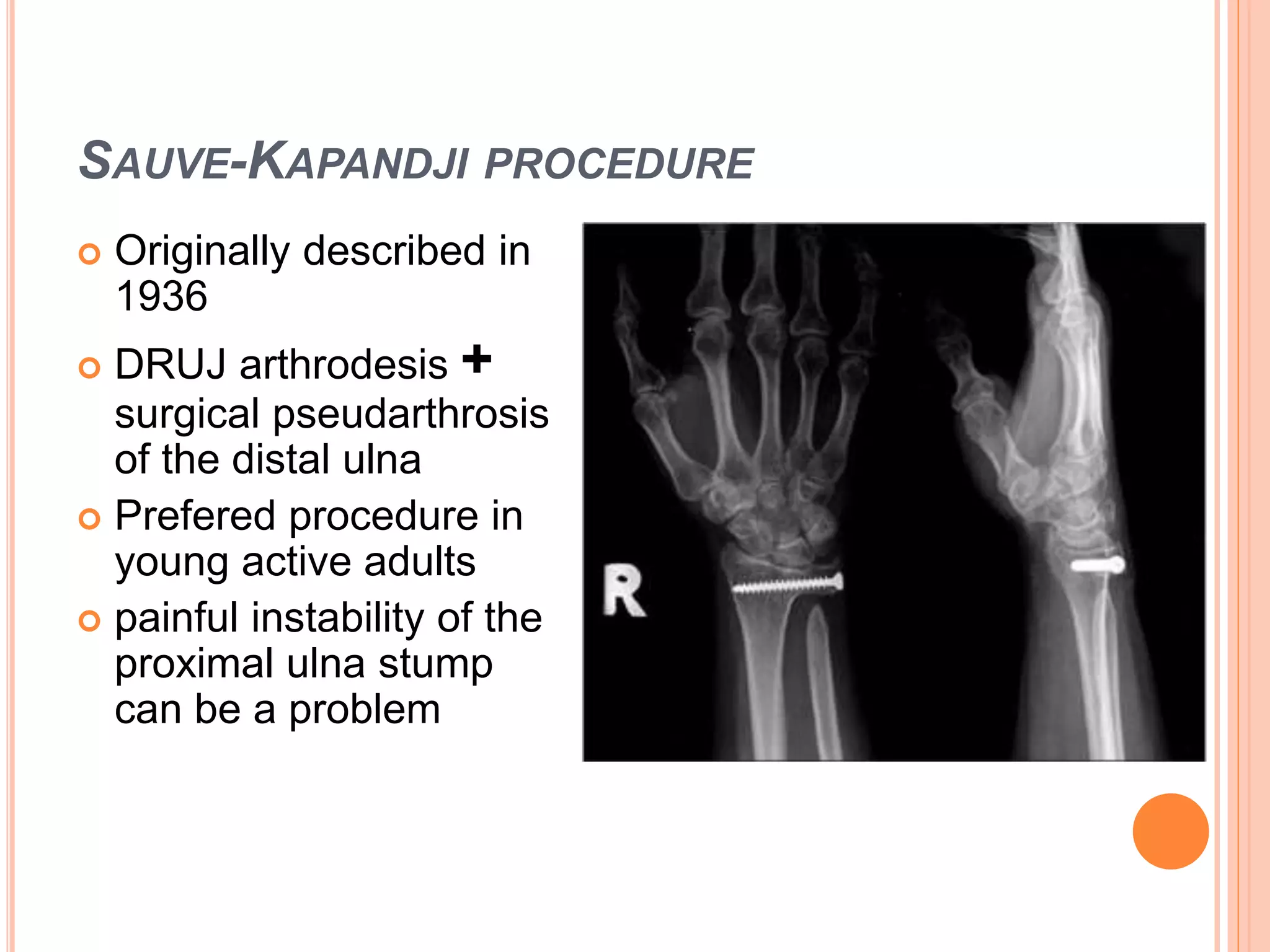Distal radioulnar joint injuries( DRUJ) and carpal instability | PPTX