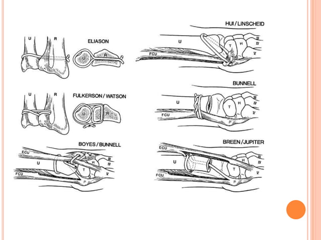 Distal radioulnar joint injuries( DRUJ) and carpal instability | PPTX