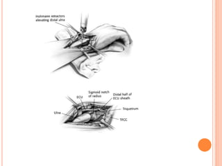 Distal radioulnar joint injuries( DRUJ) and carpal instability | PPTX