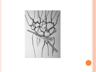 Distal radioulnar joint injuries( DRUJ) and carpal instability | PPTX