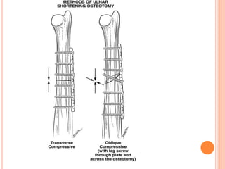 Distal radioulnar joint injuries( DRUJ) and carpal instability | PPTX