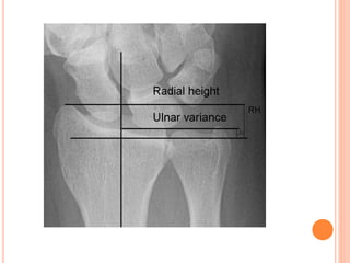 Distal radioulnar joint injuries( DRUJ) and carpal instability | PPTX