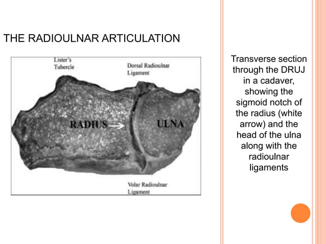 Distal radioulnar joint injuries( DRUJ) and carpal instability | PPTX