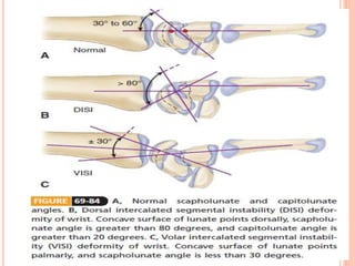 Distal radioulnar joint injuries( DRUJ) and carpal instability | PPTX