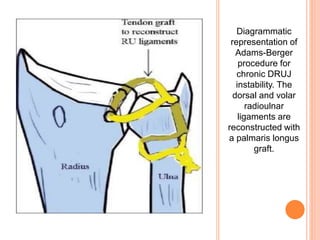 Distal radioulnar joint injuries( DRUJ) and carpal instability | PPT
