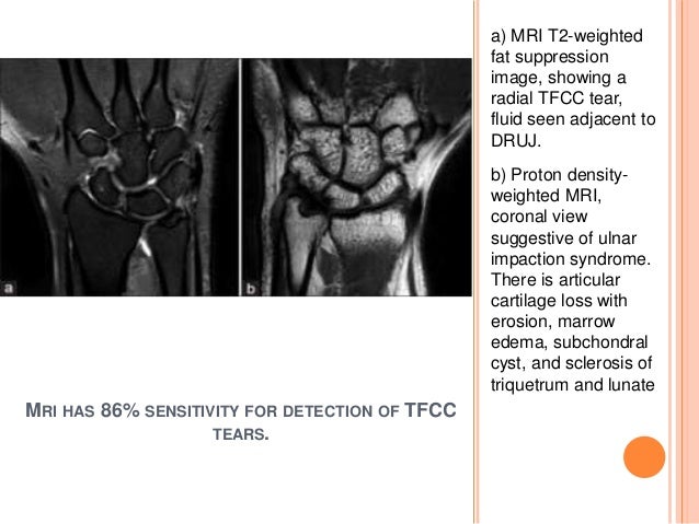 Distal radioulnar joint injuries( DRUJ) and carpal instability
