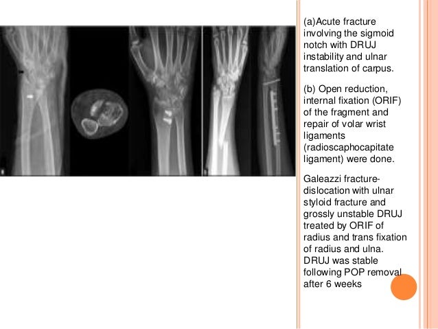 Distal radioulnar joint injuries( DRUJ) and carpal instability