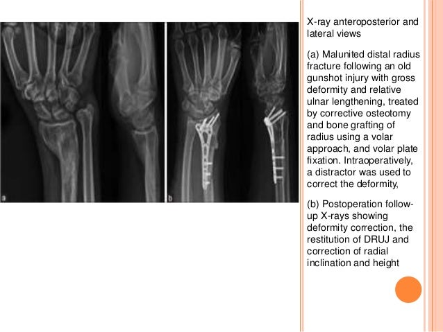 Distal radioulnar joint injuries( DRUJ) and carpal instability