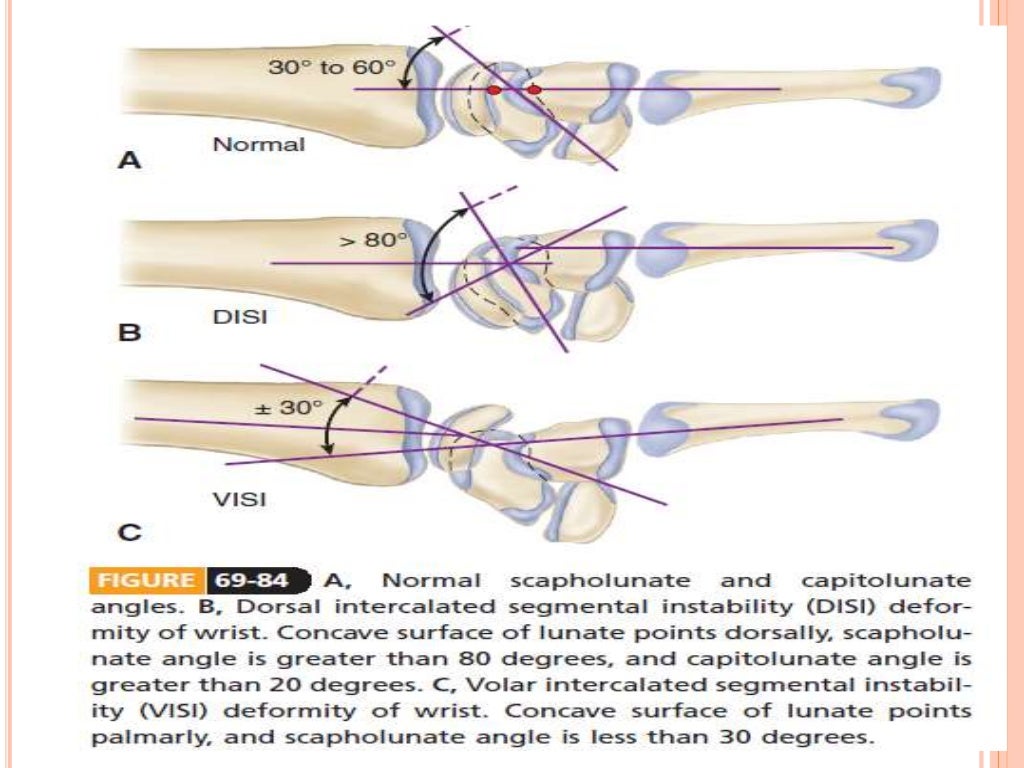 Distal radioulnar joint injuries( DRUJ) and carpal instability