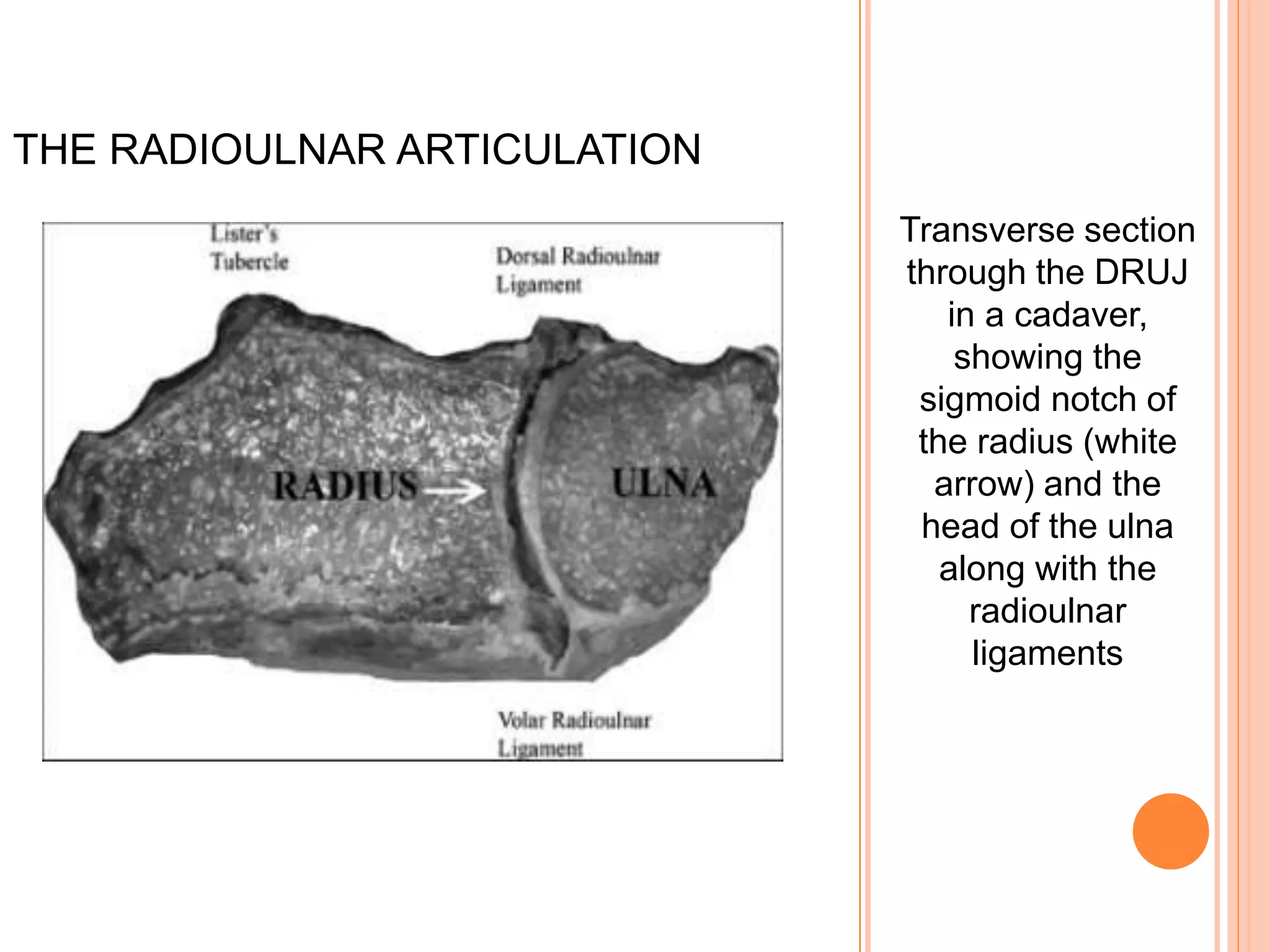 Distal radioulnar joint injuries | PPTX