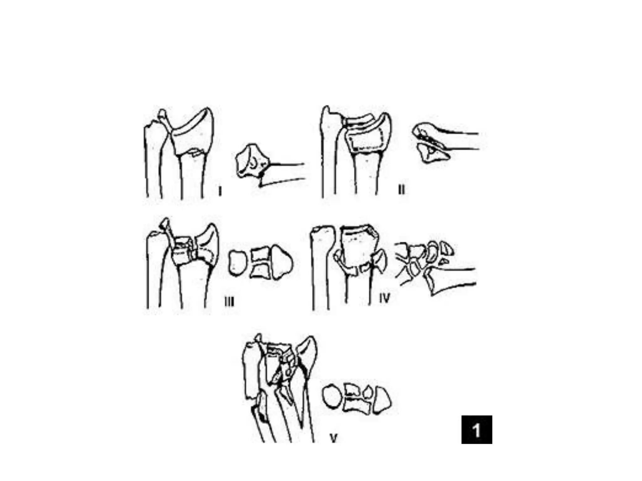 Distal radius | PPTX