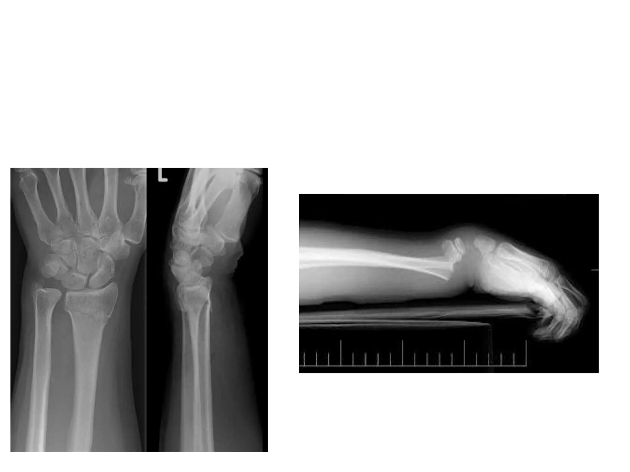 Distal radius | PPTX