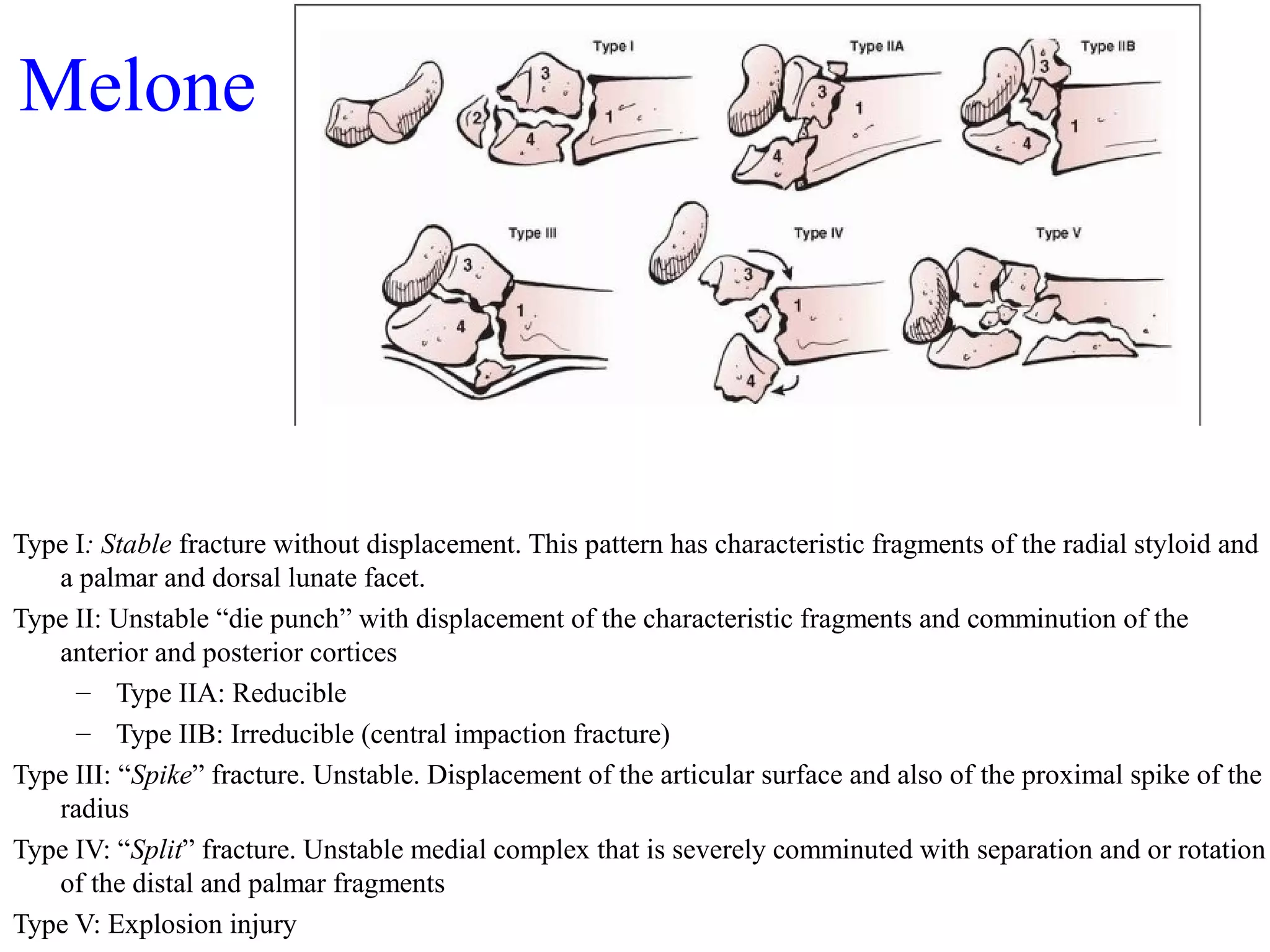 Distal radius fracture | PPT