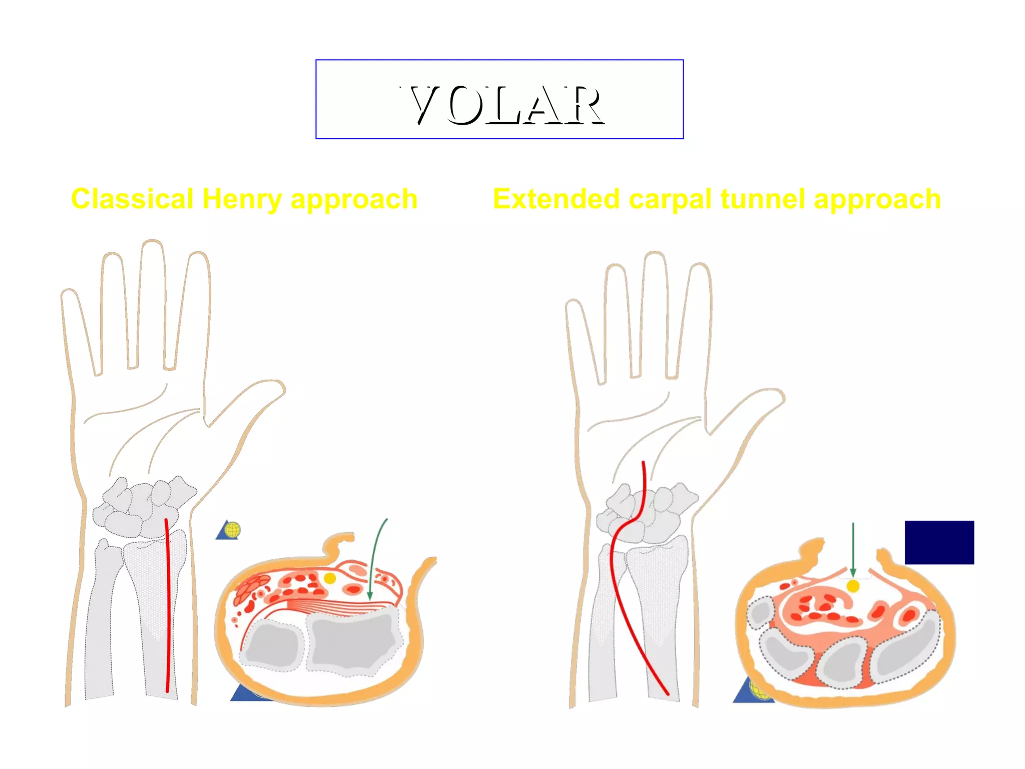 Distal radius fracture | PPT