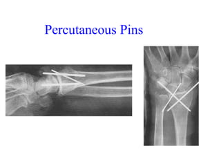 Distal radius fracture | PPT