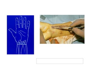 Distal radius fracture | PPT