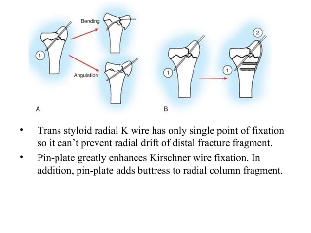 Distal radius fracture | PPT