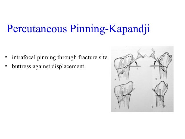 Results Of The Kapandji Procedure In The Ao Type C Distal Radius