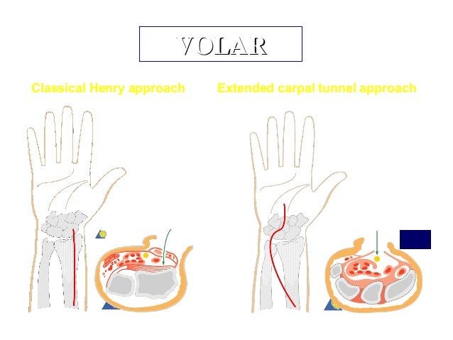 Distal radius fracture