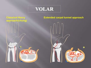 Distal radius fracture | PPTX