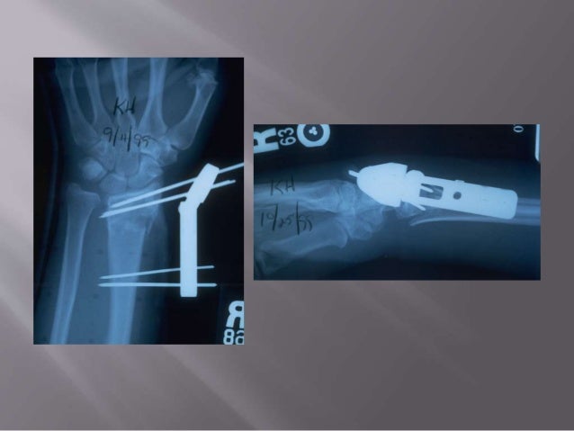 Distal Radius Fracture Kapandji Intrafocal Pinning Technique
