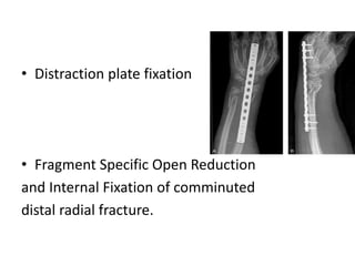 Distal radius fracture | PPTX