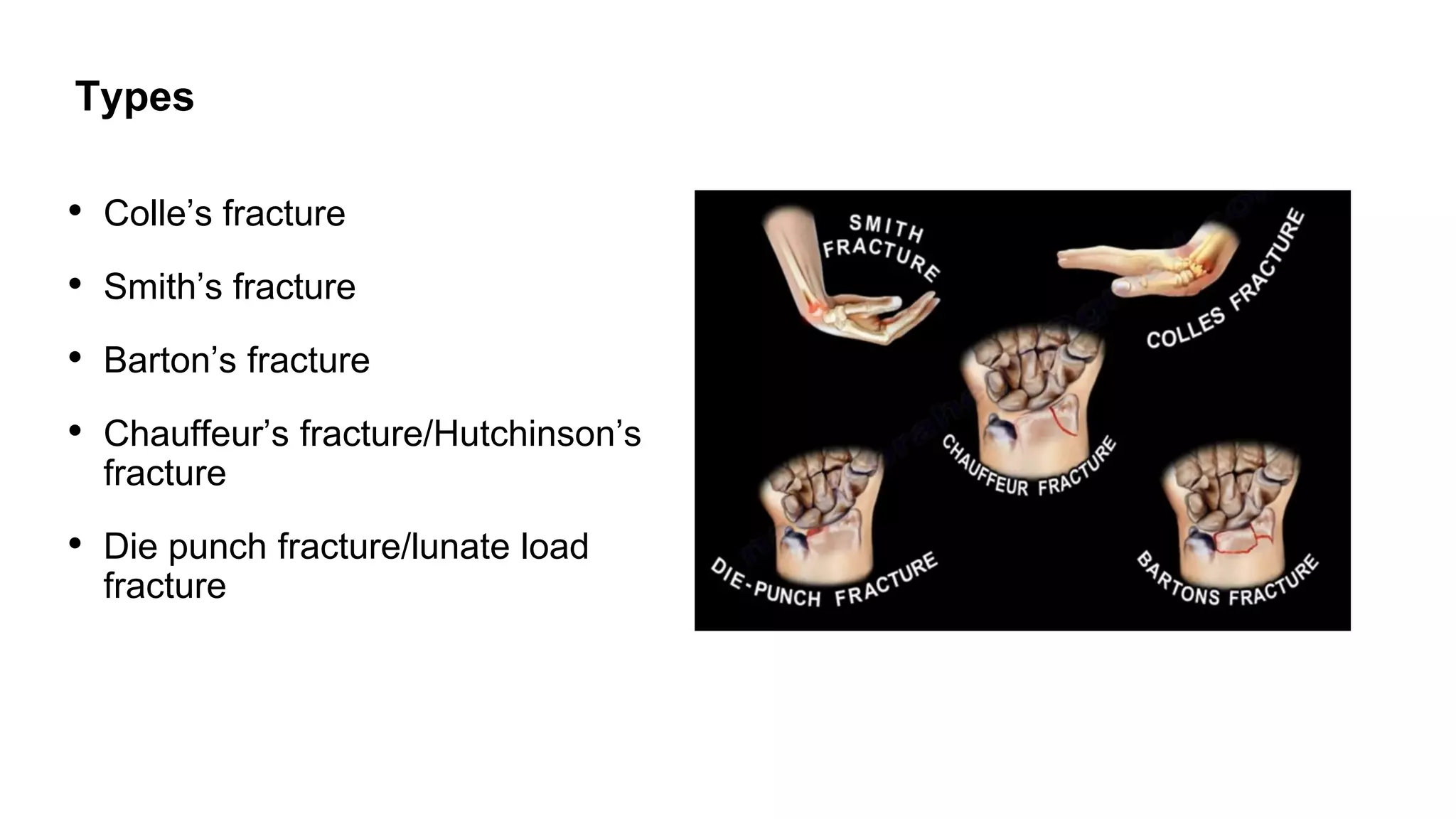Distal Radius Fracture Ppt