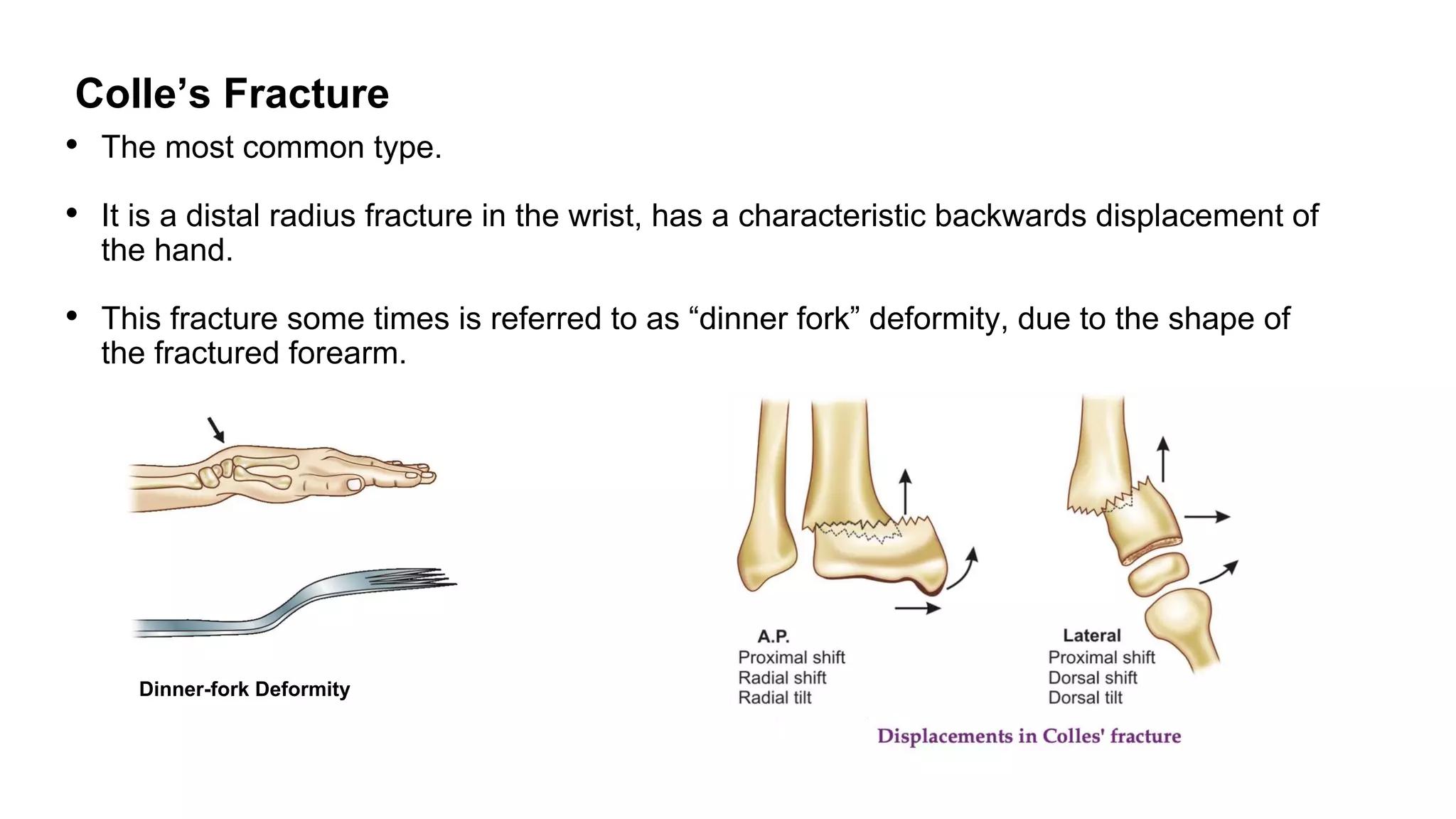 Distal radius fracture | PPTX