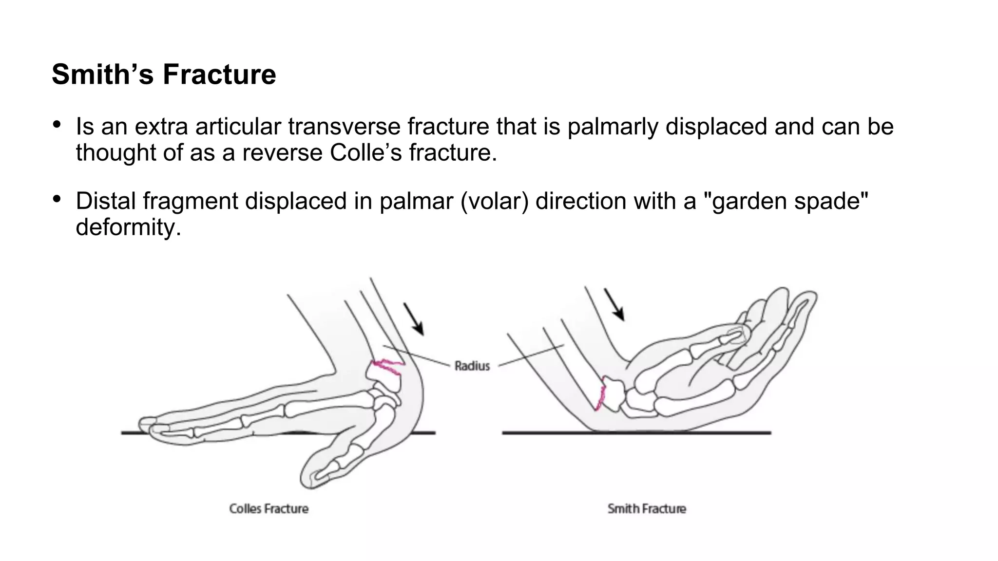 Distal radius fracture | PPTX