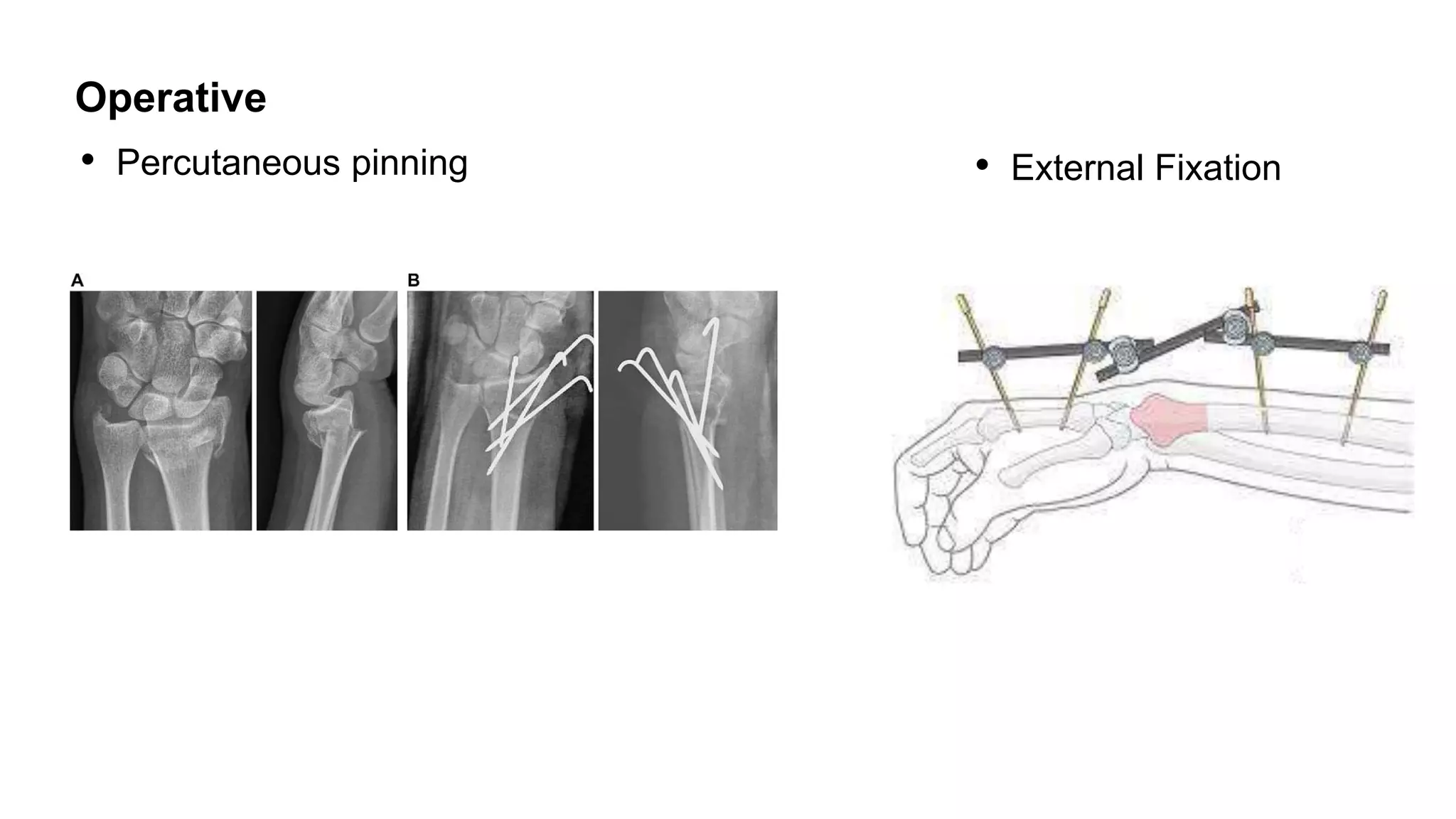 Distal radius fracture | PPTX